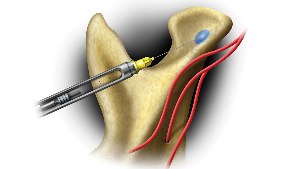 Mandibular Nerve Block