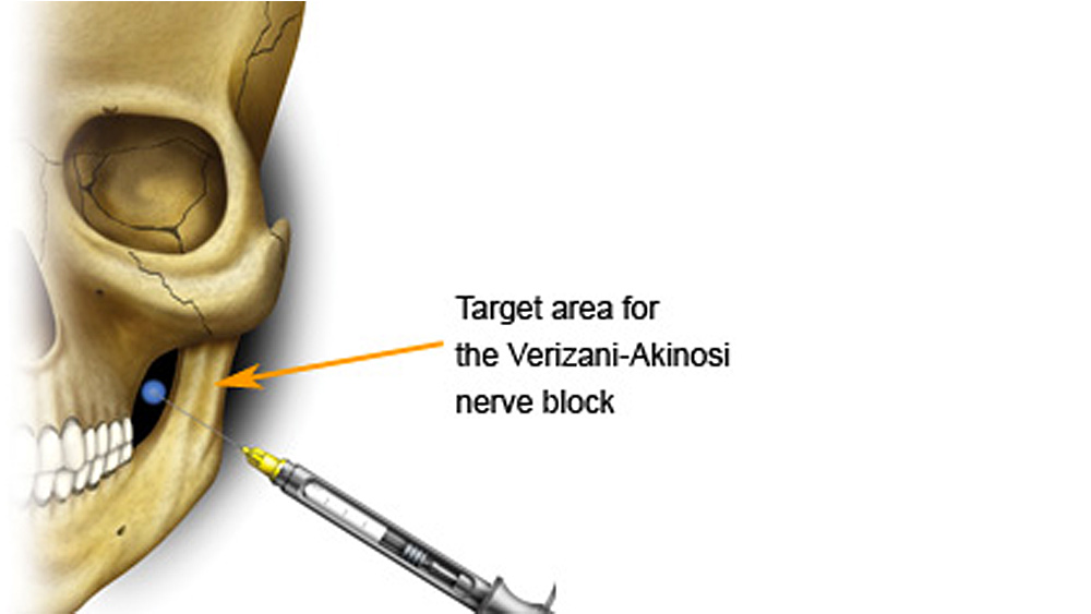 Mandibular Nerve Block