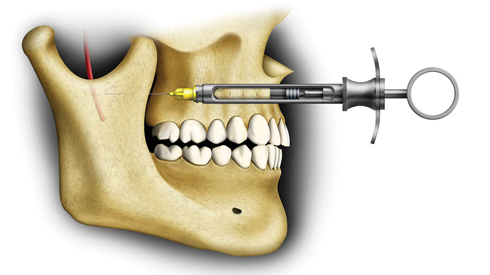 Inferior Alveolar Nerve Block Alternative Technique