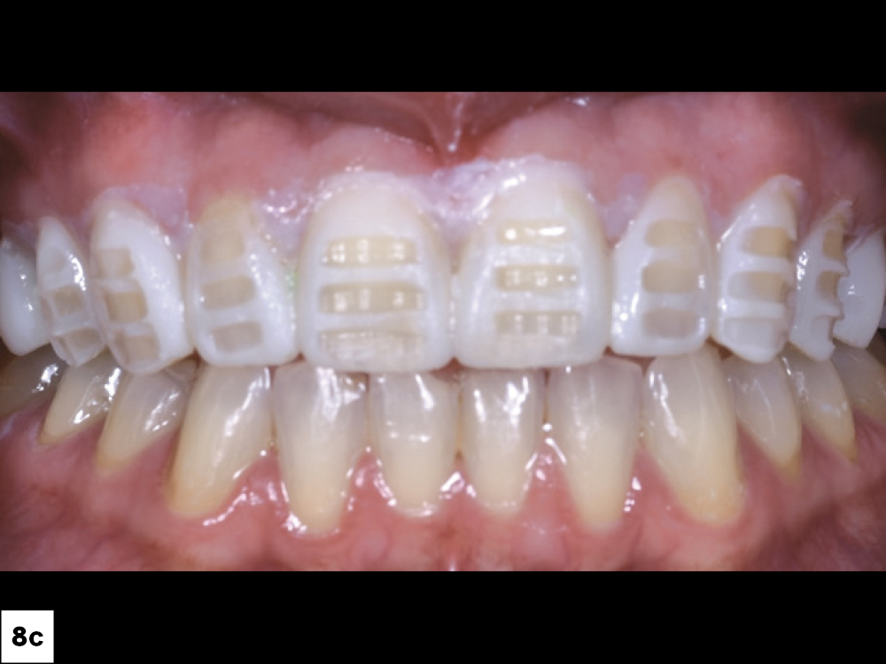 veneers teeth preparation
