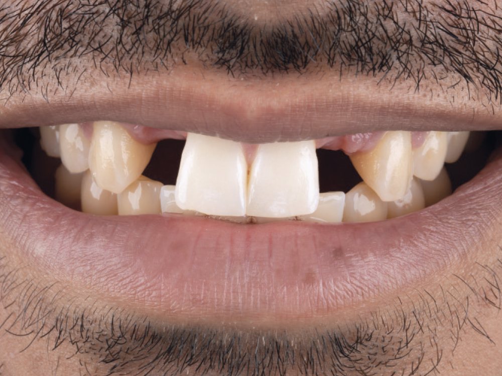 Real Vampire Teeth Implants