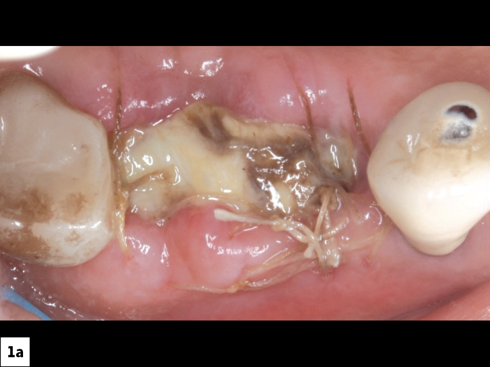 Granulation Tissue Mouth