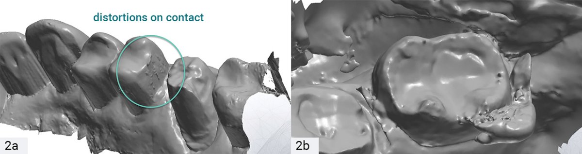 3 Mistakes You Don't Want to Make with Digital Impressions | Glidewell