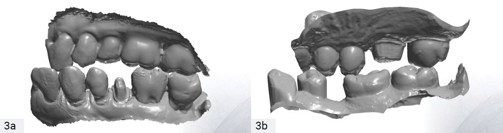 3 Mistakes You Don't Want to Make with Digital Impressions | Glidewell