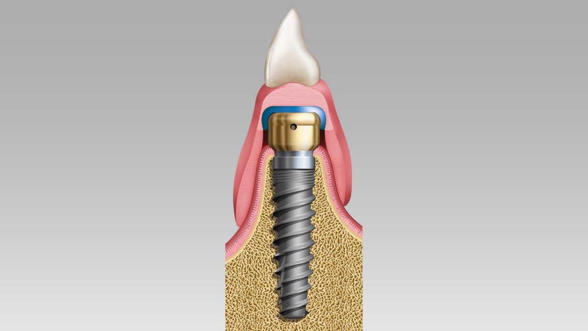 Implant-Supported Dentures: General Practice | Glidewell