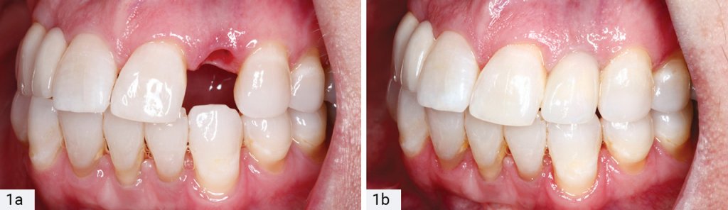 4 Key Questions About Screw-Retained Crowns | Glidewell