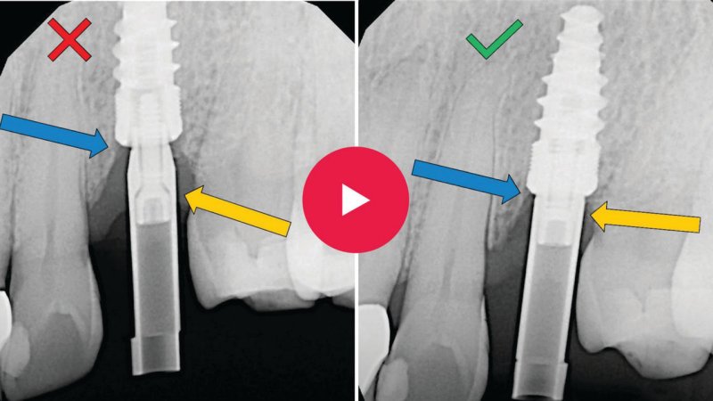 Enhance Digital Workflows with Precision Scan Bodies