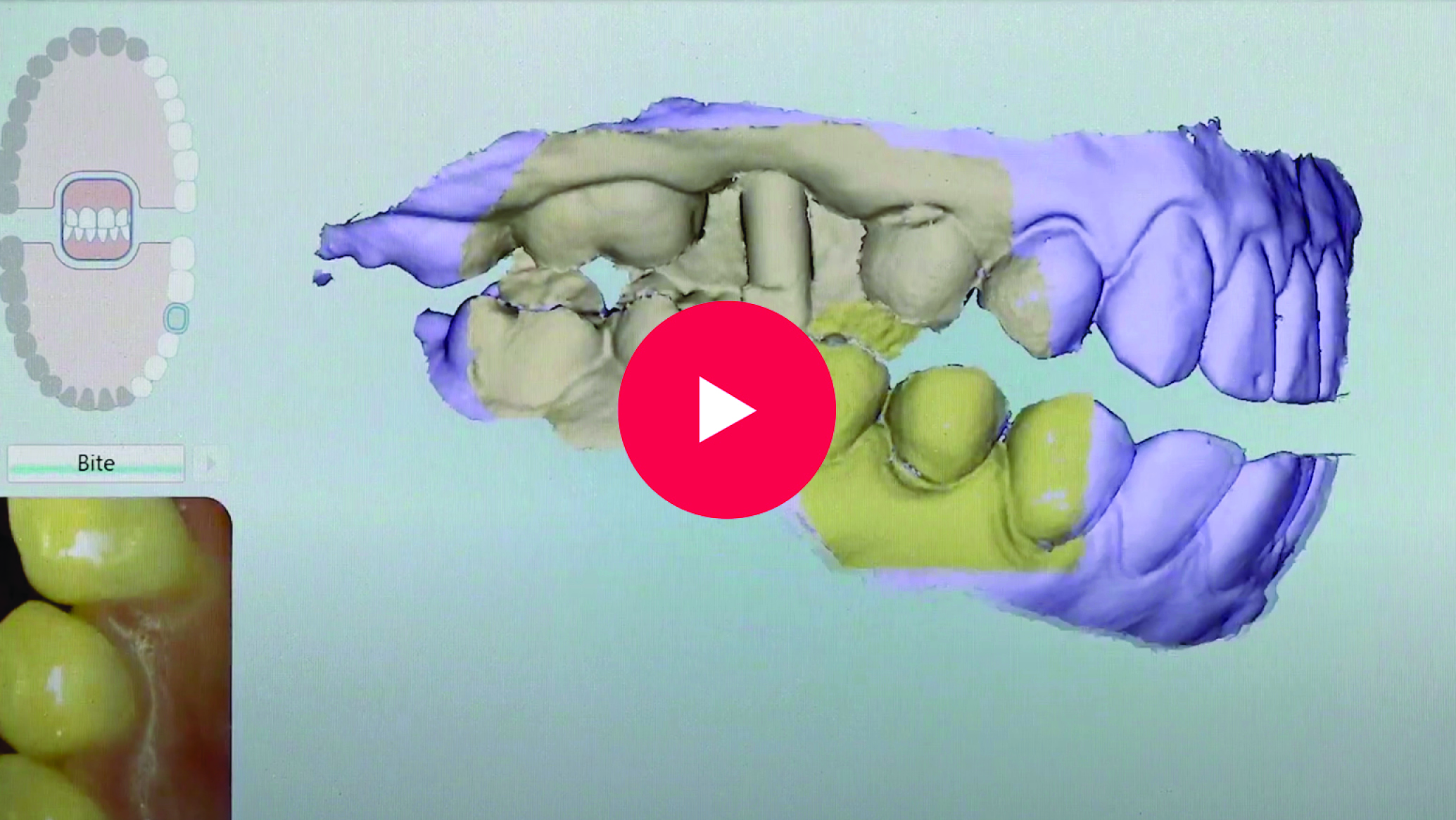 Enhance Digital Workflows with Precision Scan Bodies