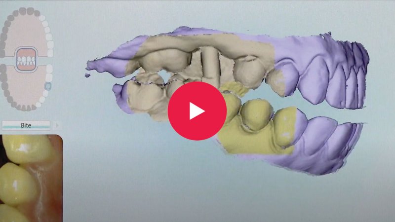 Enhance Digital Workflows with Precision Scan Bodies