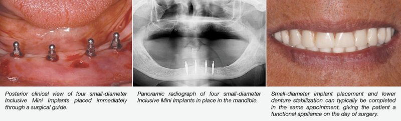 Geriatric Dentistry: 5 Things You Need to Know | Glidewell