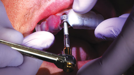 How and Why to Use Guided Implant Surgery | Glidewell