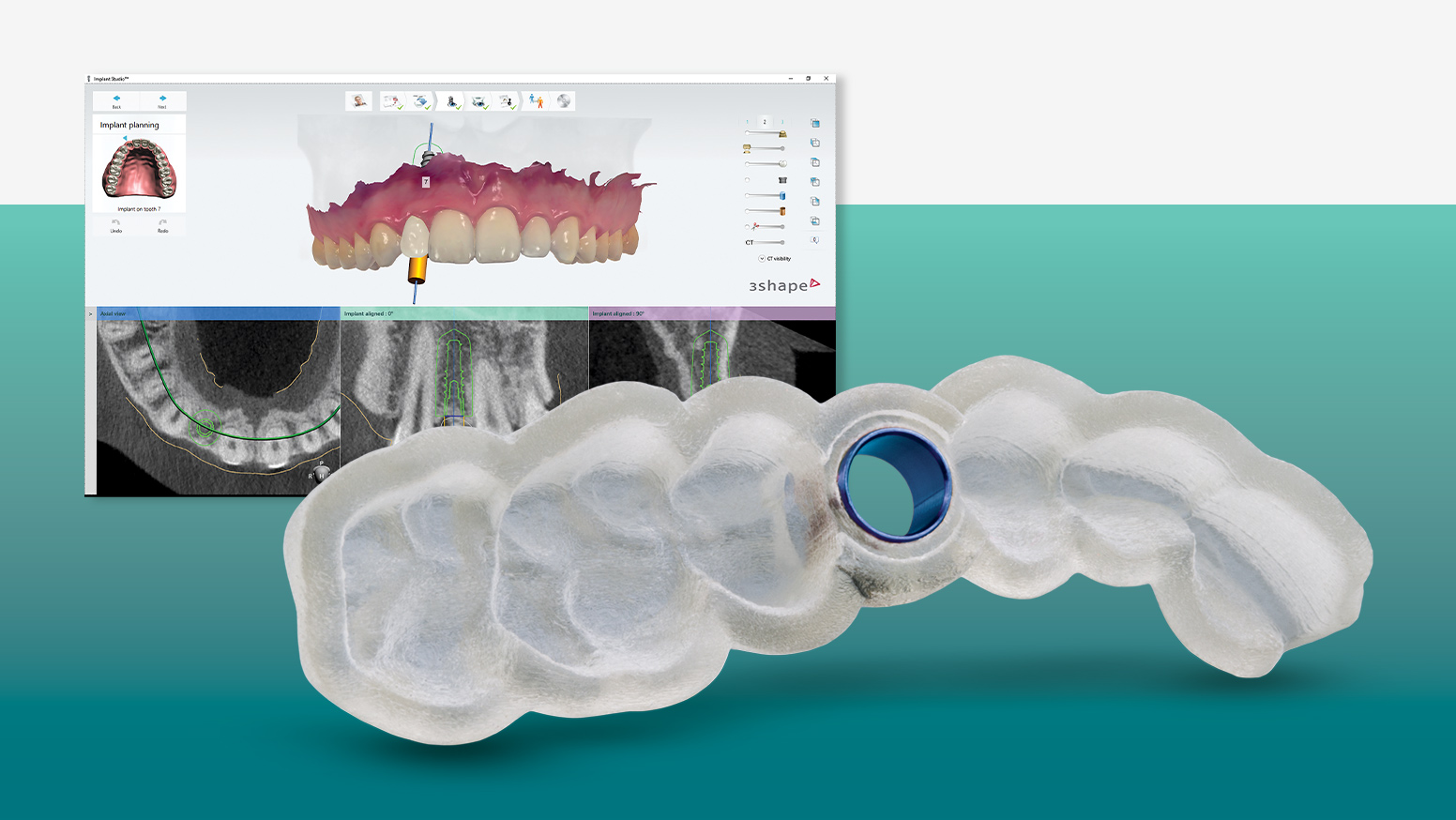 How and Why to Use Guided Implant Surgery | Glidewell