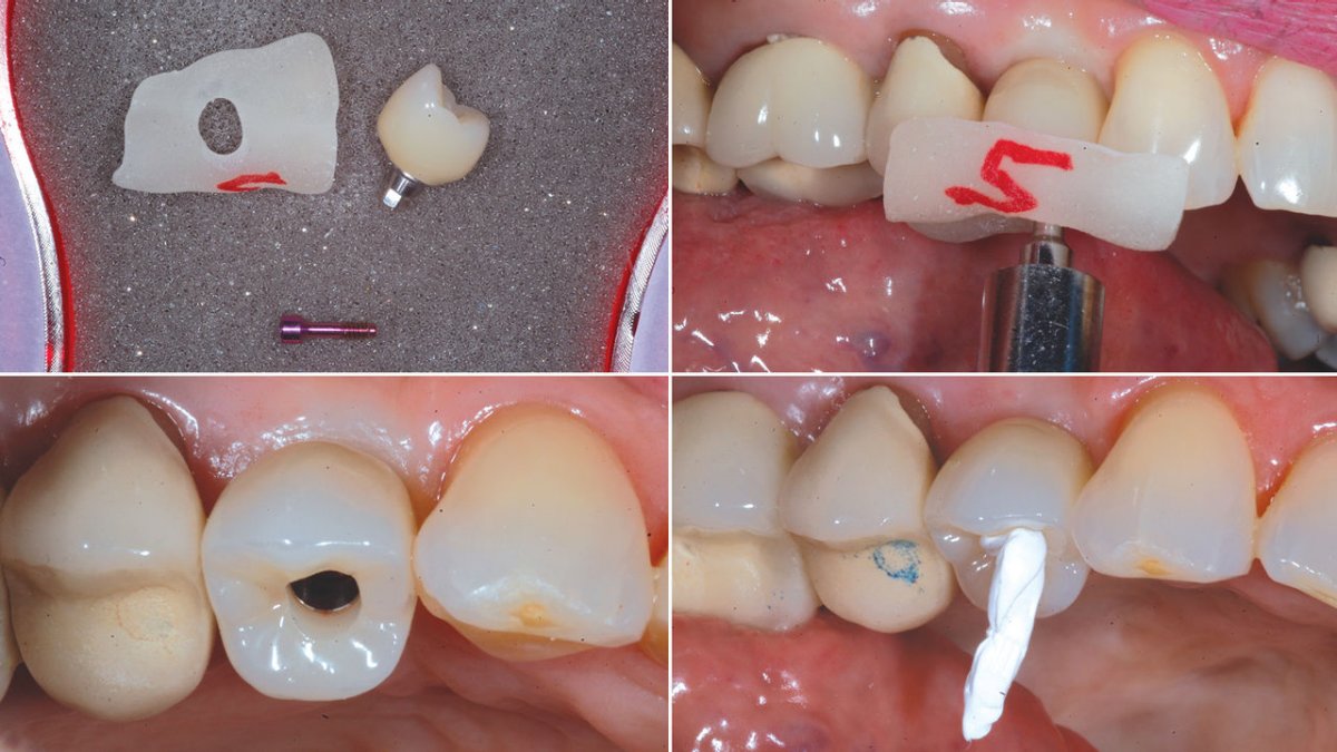 5 Ways to Achieve Accurate Fit for Screw-Retained Crowns