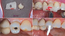 5 Ways to Achieve Accurate Fit for Screw-Retained Crowns
