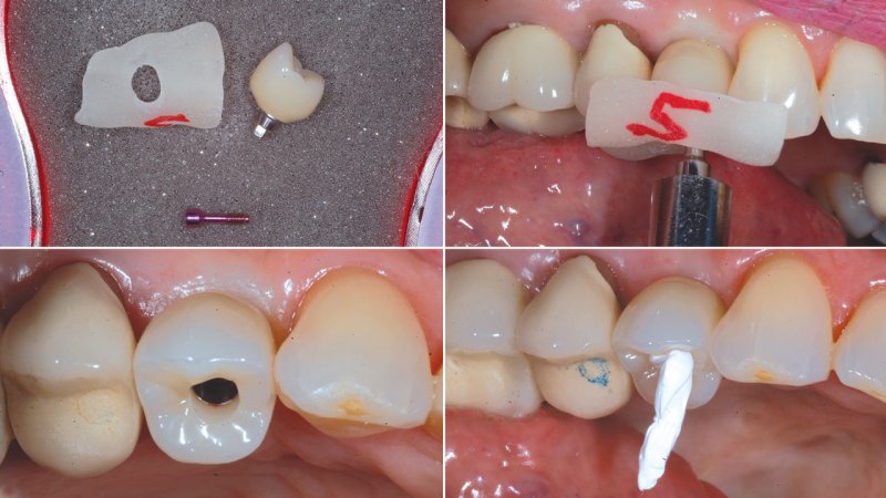 5 Ways to Achieve Accurate Fit for Screw-Retained Crowns