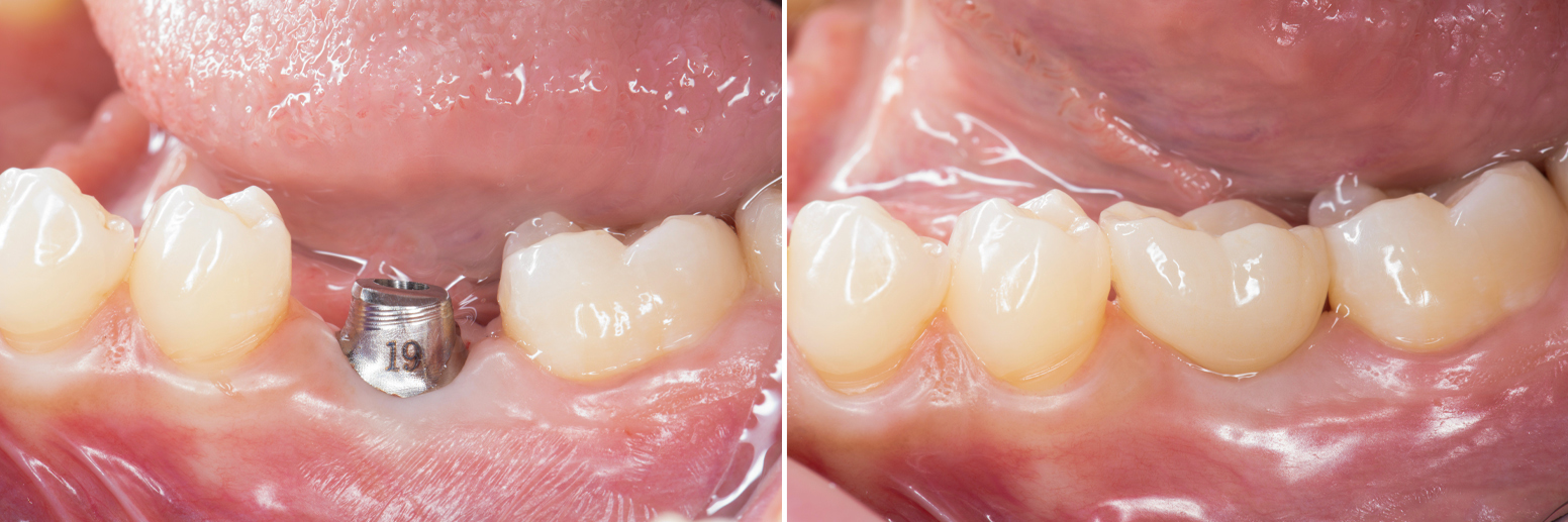 5 Ways to Achieve Accurate Fit for Screw-Retained Crowns