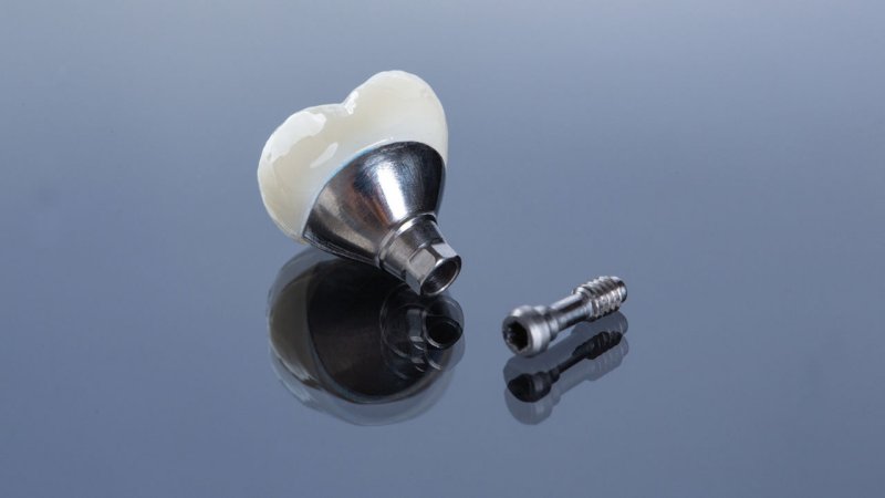 5 Ways to Achieve Accurate Fit for Screw-Retained Crowns