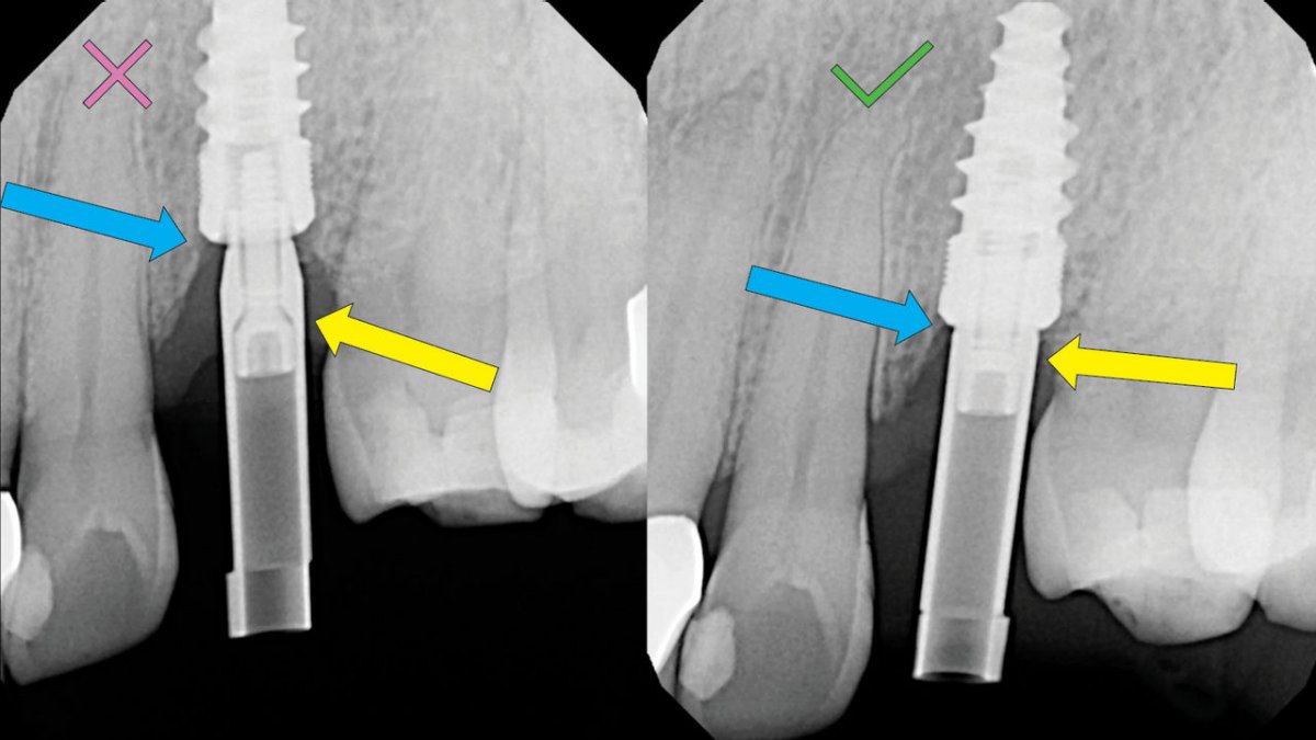 5 Ways to Achieve Accurate Fit for Screw-Retained Crowns