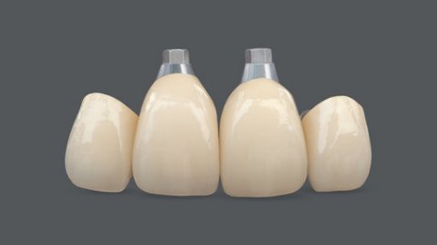 5 Ways to Achieve Accurate Fit for Screw-Retained Crowns