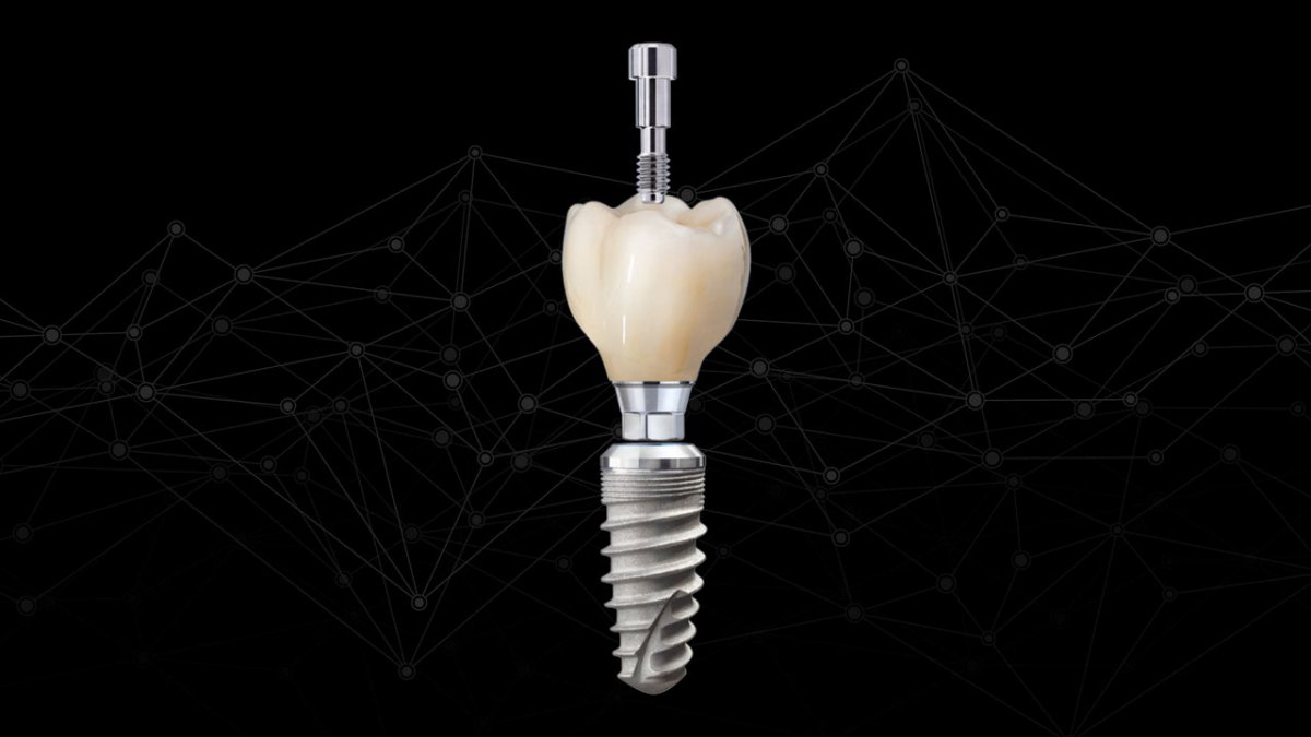 5 Ways to Achieve Accurate Fit for Screw-Retained Crowns
