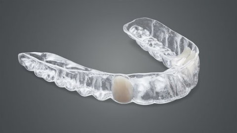 Essix Retainers vs. Flippers: A Clinical Comparison