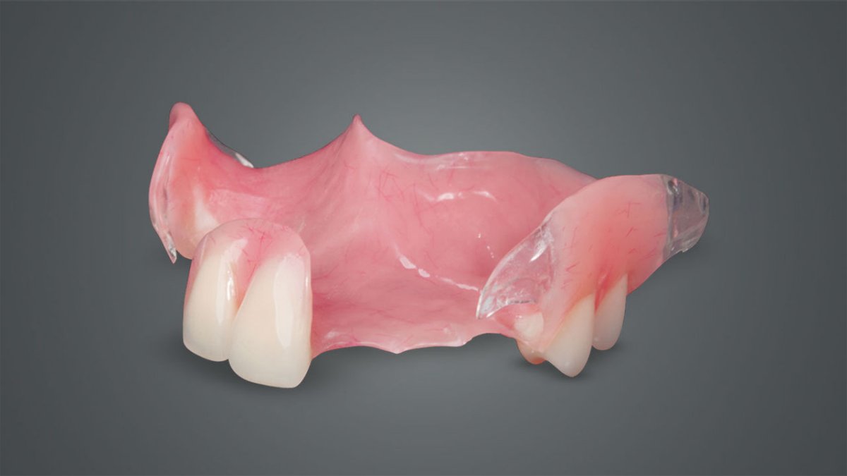 Essix Retainers vs. Flippers: A Clinical Comparison