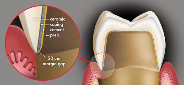 Choosing Between Zirconia Crowns and PFM Crowns | Glidewell