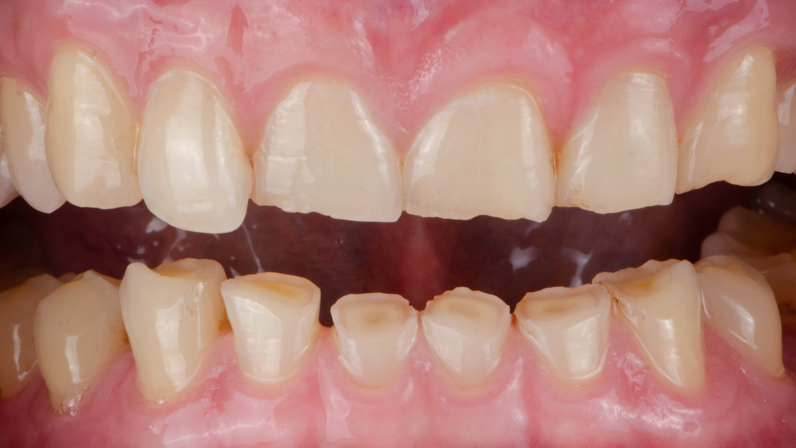 Grind Your Teeth? Got a CPAP? It’s Time for a Dental Appliance | Glidewell