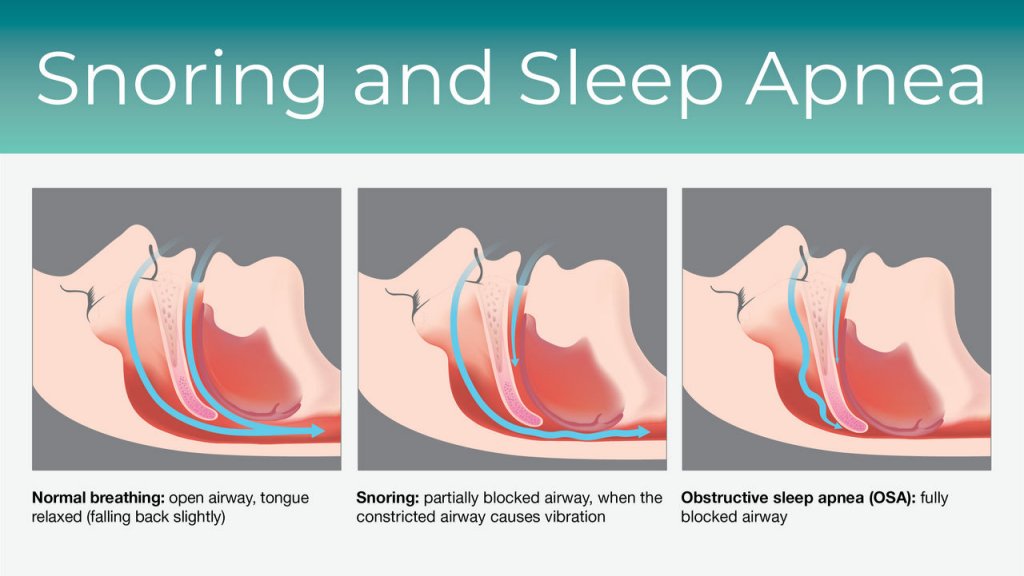 How Are Snoring and Sleep Apnea Different?