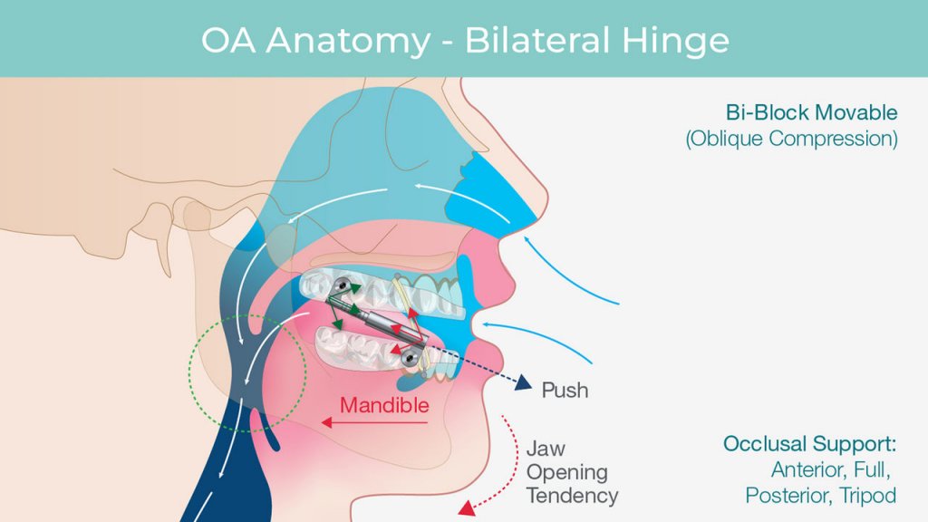 Herbst Appliance: A Popular Snoring Device | Glidewell