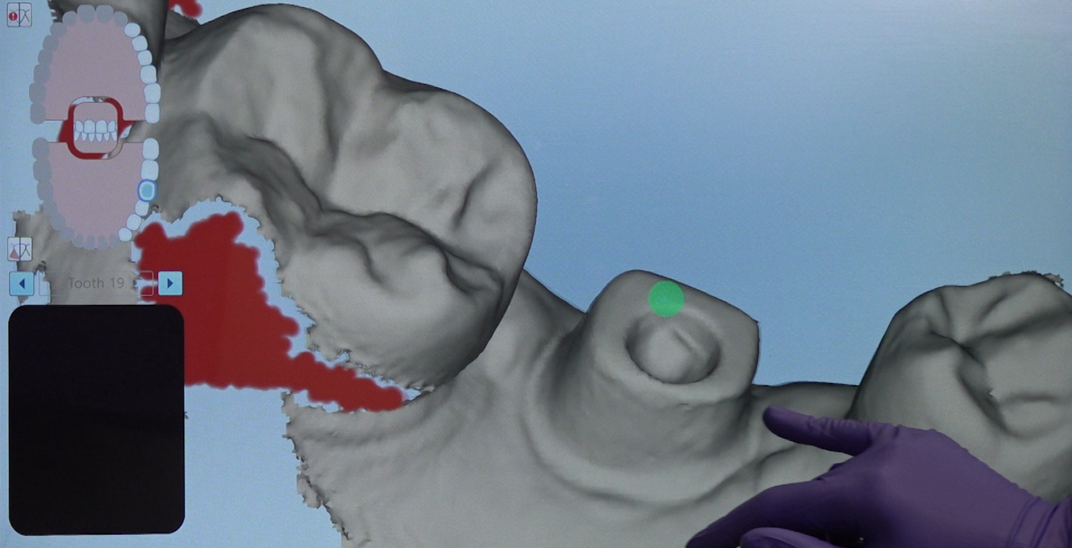 Mastering Accurate Digital Dental Impressions | Glidewell