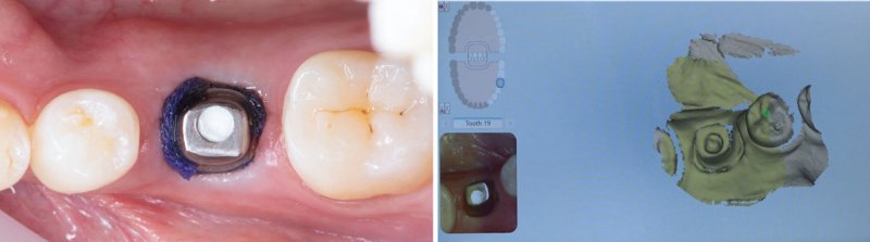 Mastering Accurate Digital Dental Impressions | Glidewell