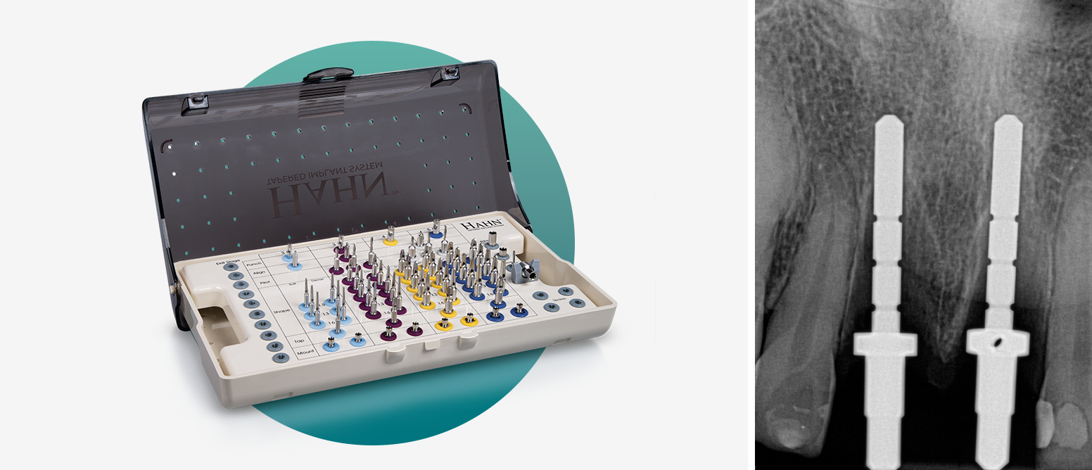 7 Simple Steps to Immediate Dental Implant Placement | Glidewell