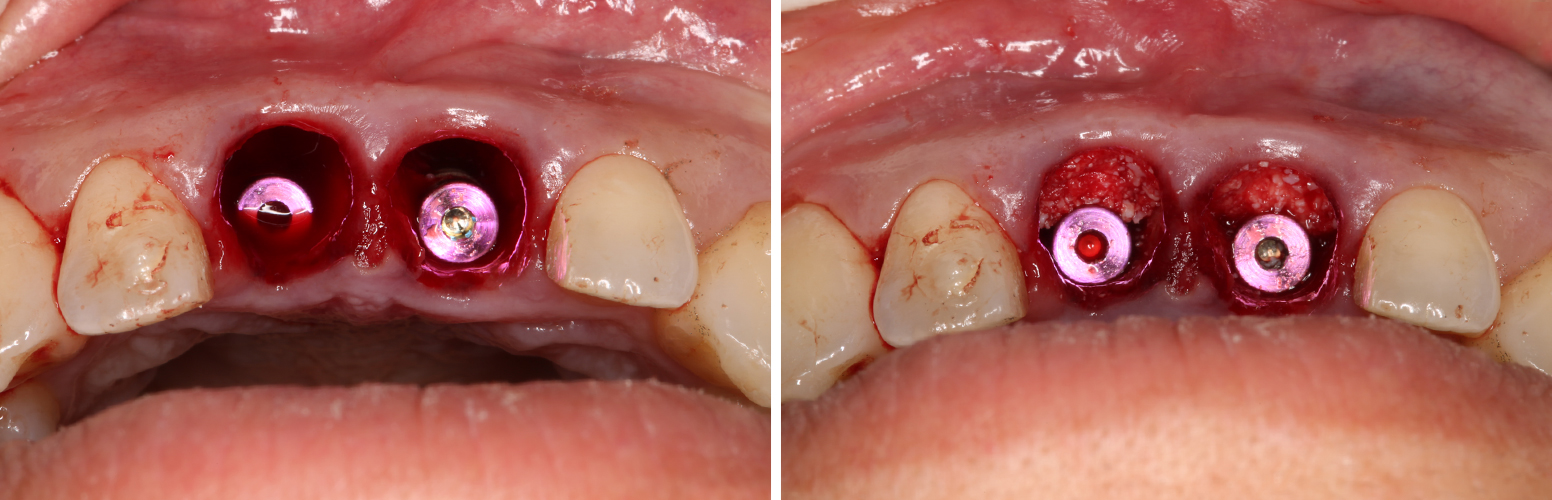 7 Simple Steps to Immediate Dental Implant Placement | Glidewell