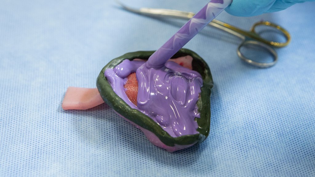 How to Take Quality Denture Impressions | Glidewell