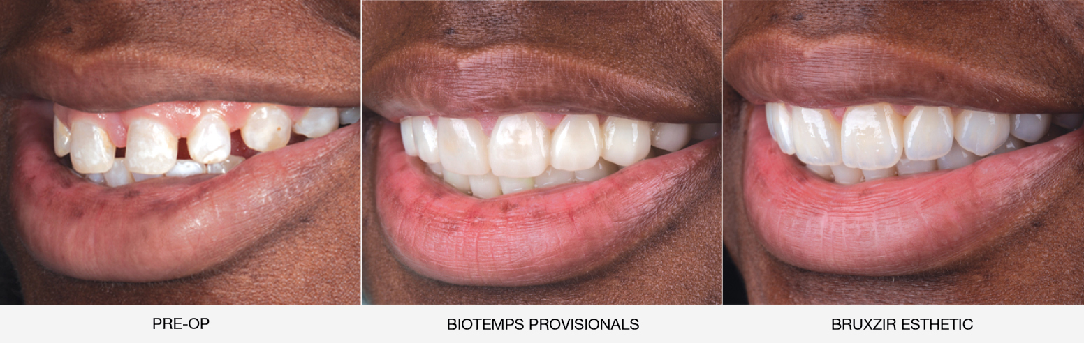 How to Use Temporary Dental Crowns to Boost Treatment Results