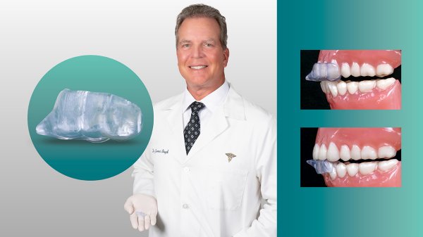 Myths, Migraines and the NTI-tss Plus® | Glidewell