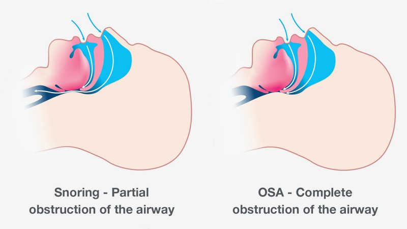 Dental Billing Codes for Sleep Apnea Treatment | Glidewell