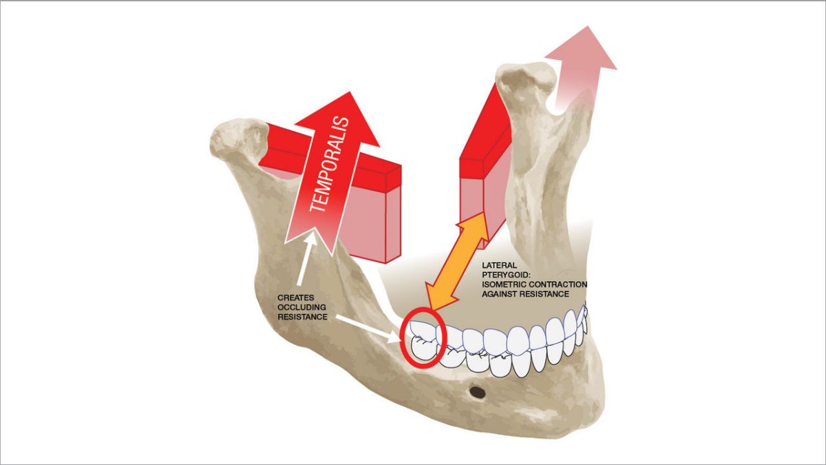 New Study Supports the NTI Device for TMJ and Migraine Pain | Glidewell