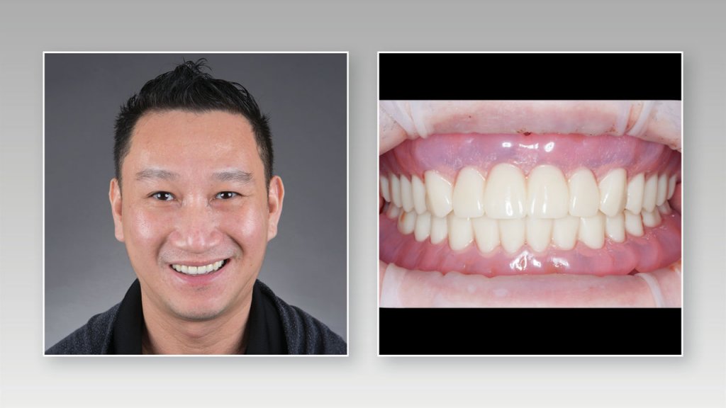 Successful Complete Dentures: Tips & Techniques | Glidewell