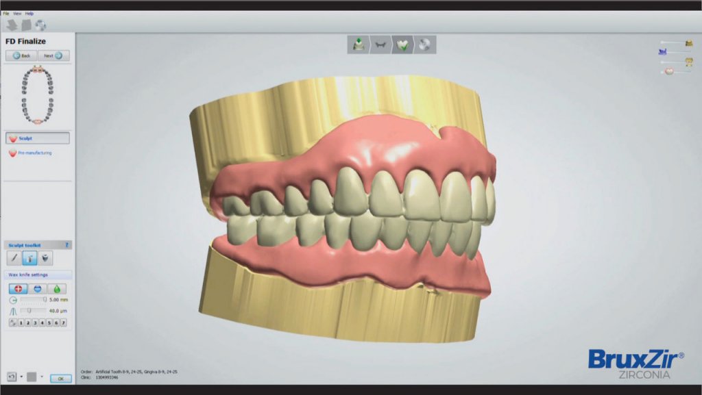 3D-Printed Immediate Dentures: Advantages Explained