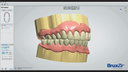 3D-Printed Immediate Dentures: Advantages Explained