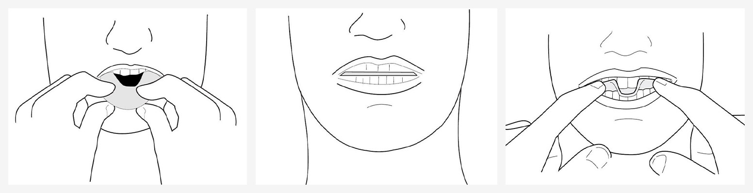AM Aligner Corrects Temporary Morning Bite Change | Glidewell