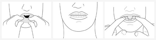 AM Aligner Corrects Temporary Morning Bite Change | Glidewell