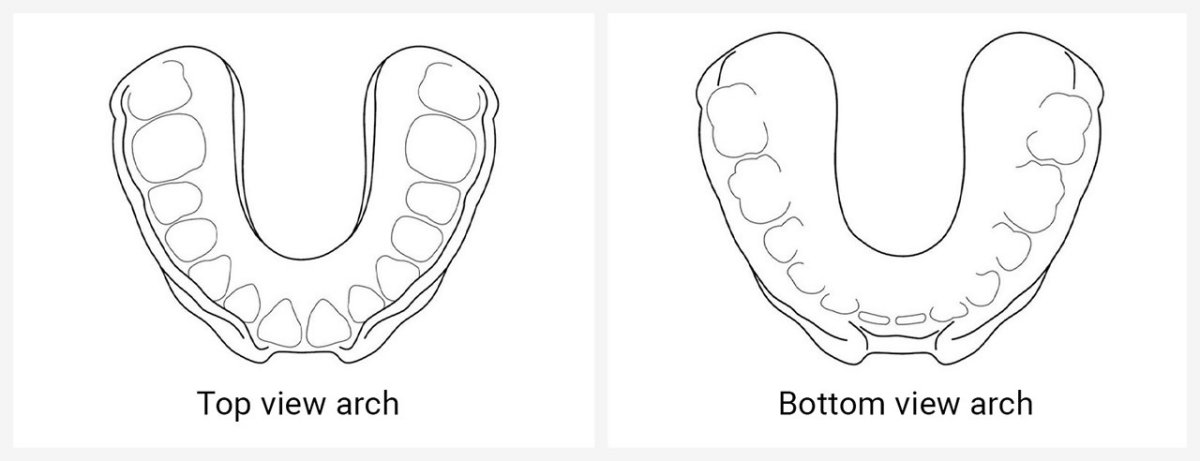 AM Aligner Corrects Temporary Morning Bite Change | Glidewell