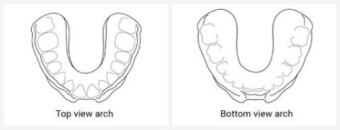AM Aligner Corrects Temporary Morning Bite Change | Glidewell
