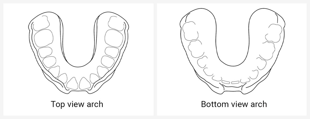 AM Aligner Corrects Temporary Morning Bite Change | Glidewell