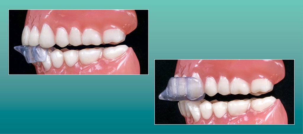 What I Learned from a Decade of NTI Treatments | Glidewell