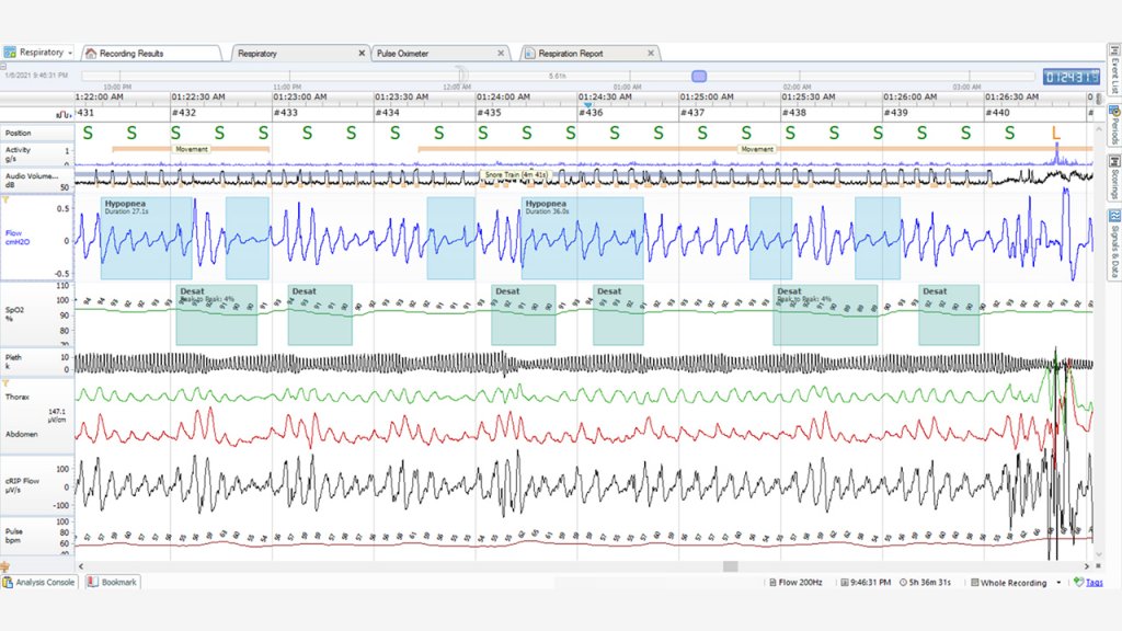 What Is Obstructive Sleep Apnea? | Glidewell