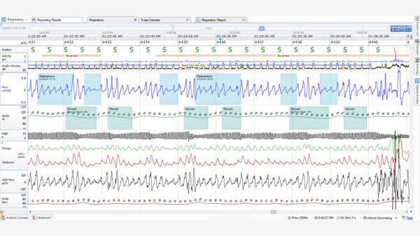 What Is Obstructive Sleep Apnea? | Glidewell